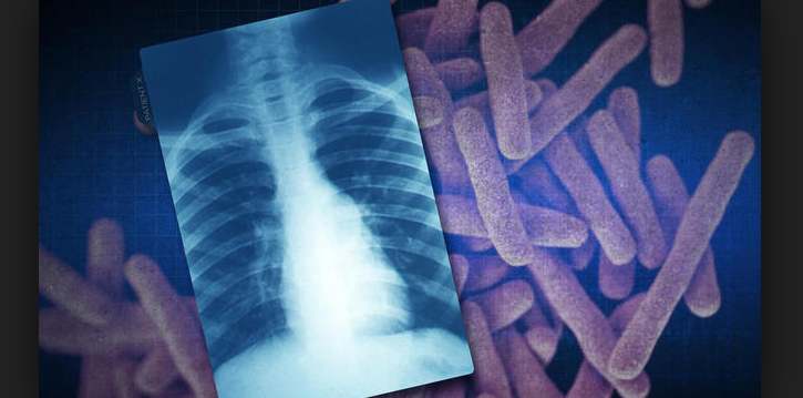 Apa Itu Tuberculosis? 5 Cara Sembuh Dari Penyakit Ini